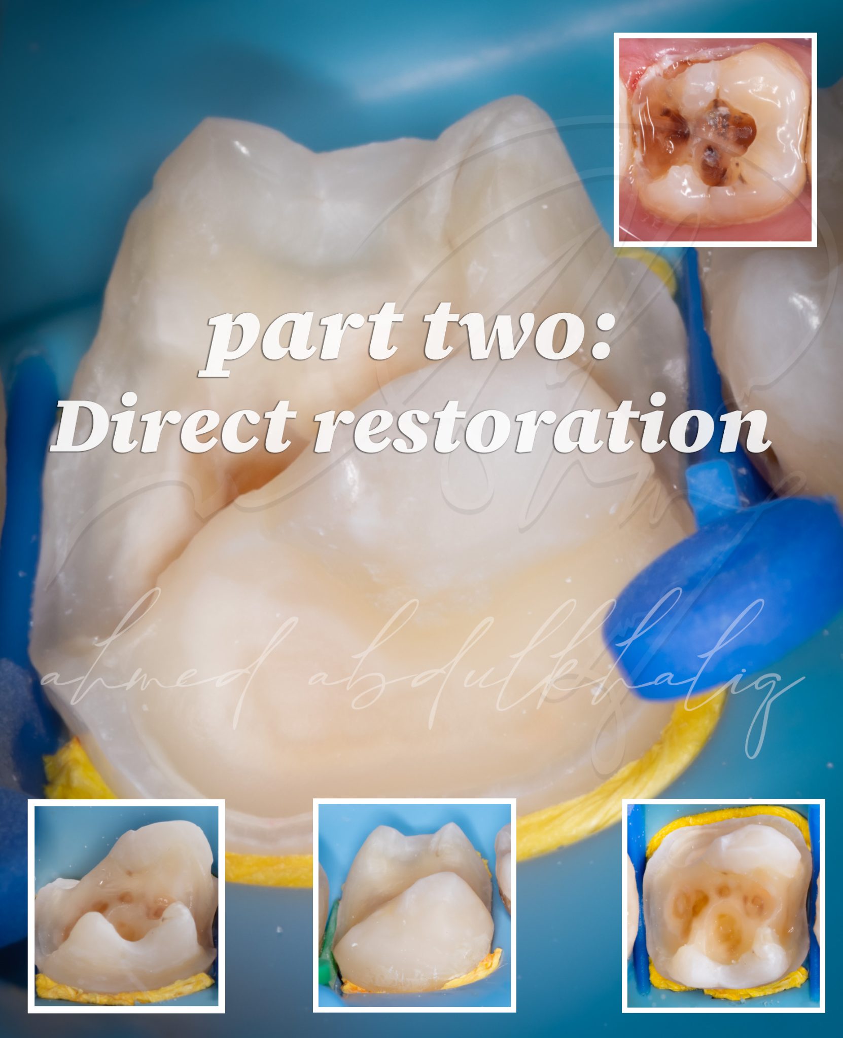 indirect restoration (1 y follow up) Vs Direct restoration (3 months ...