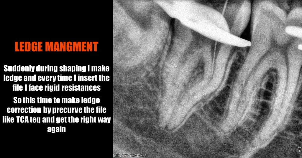 Complex anatomy in endodontic treatment and how to deal with - MyZerodonto
