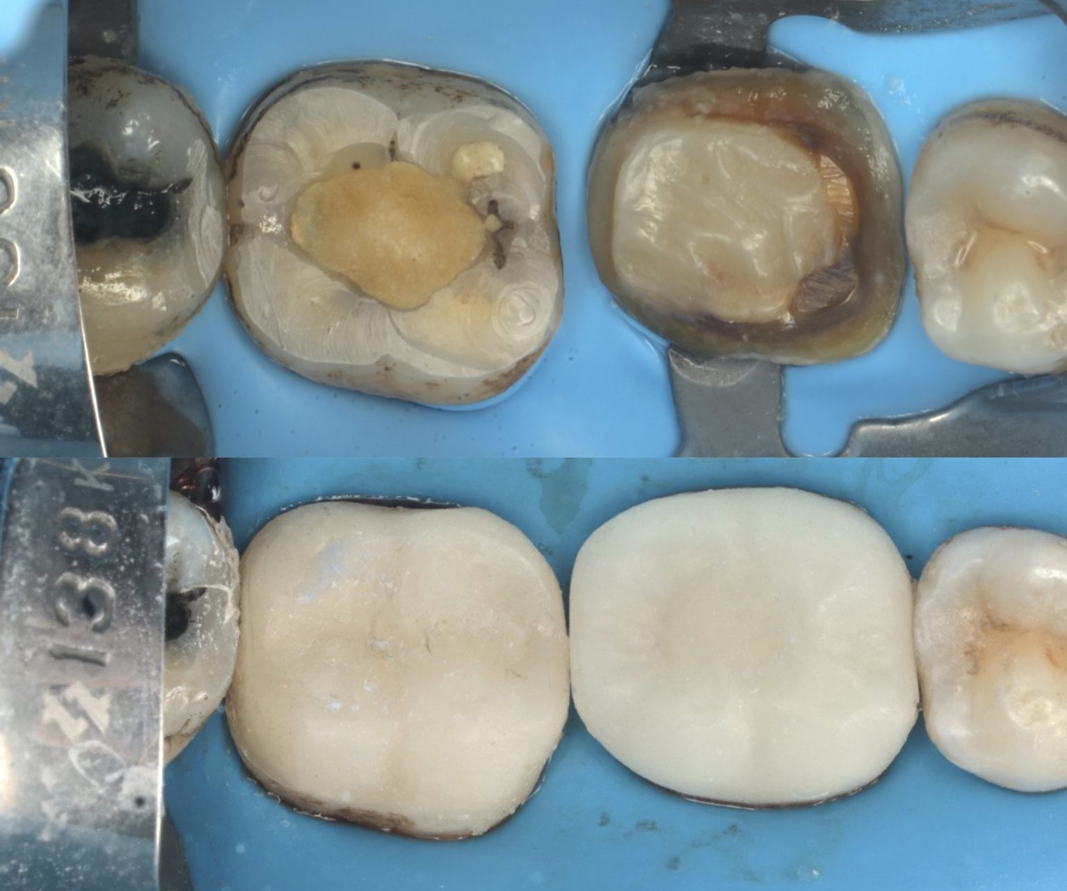 Indirect Hybrid Composite Restorations - MyZerodonto