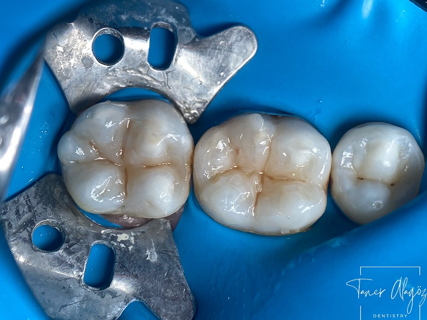 Posterior Direct Composite Restoration - MyZerodonto
