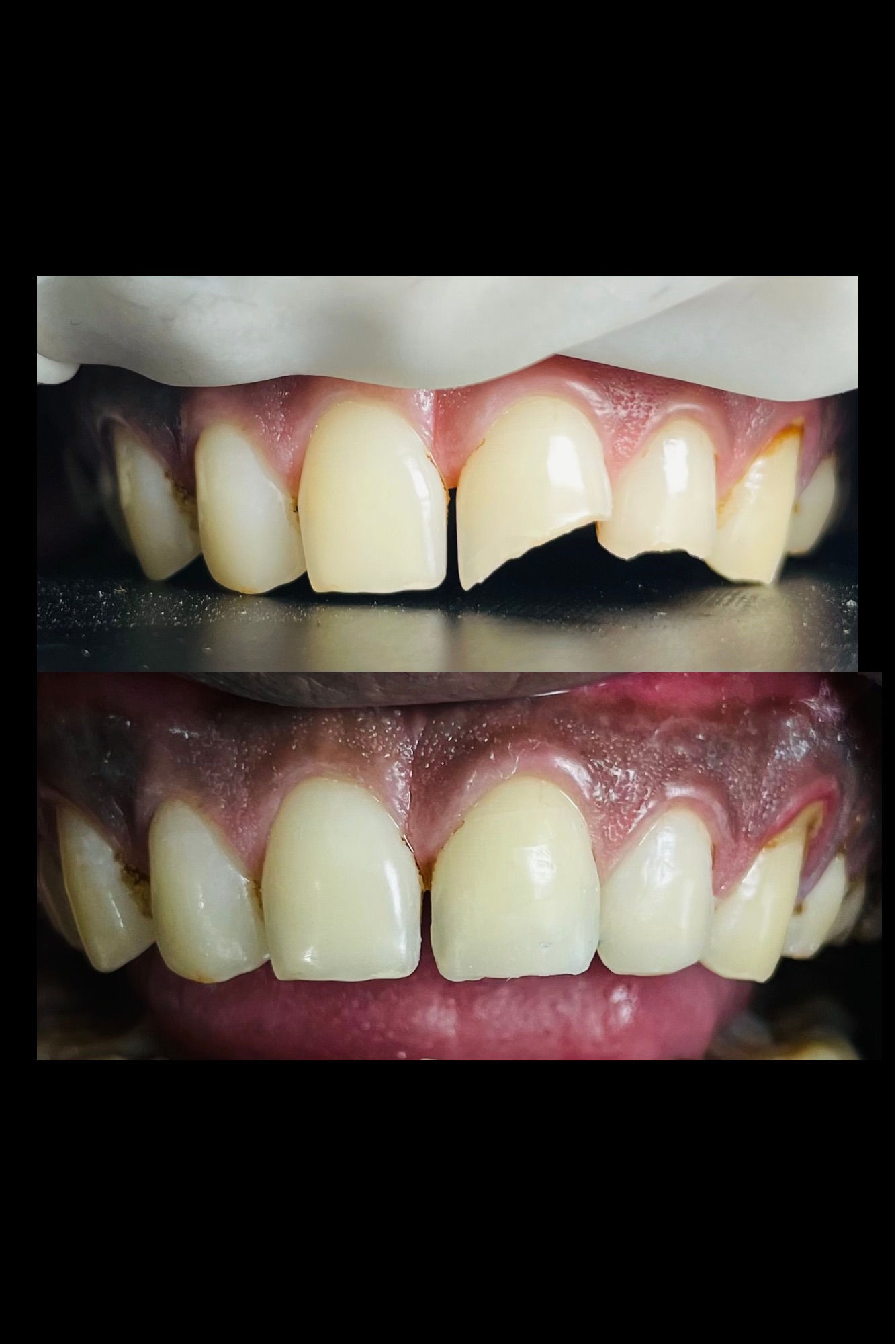 Restoring the broken smile! - MyZerodonto