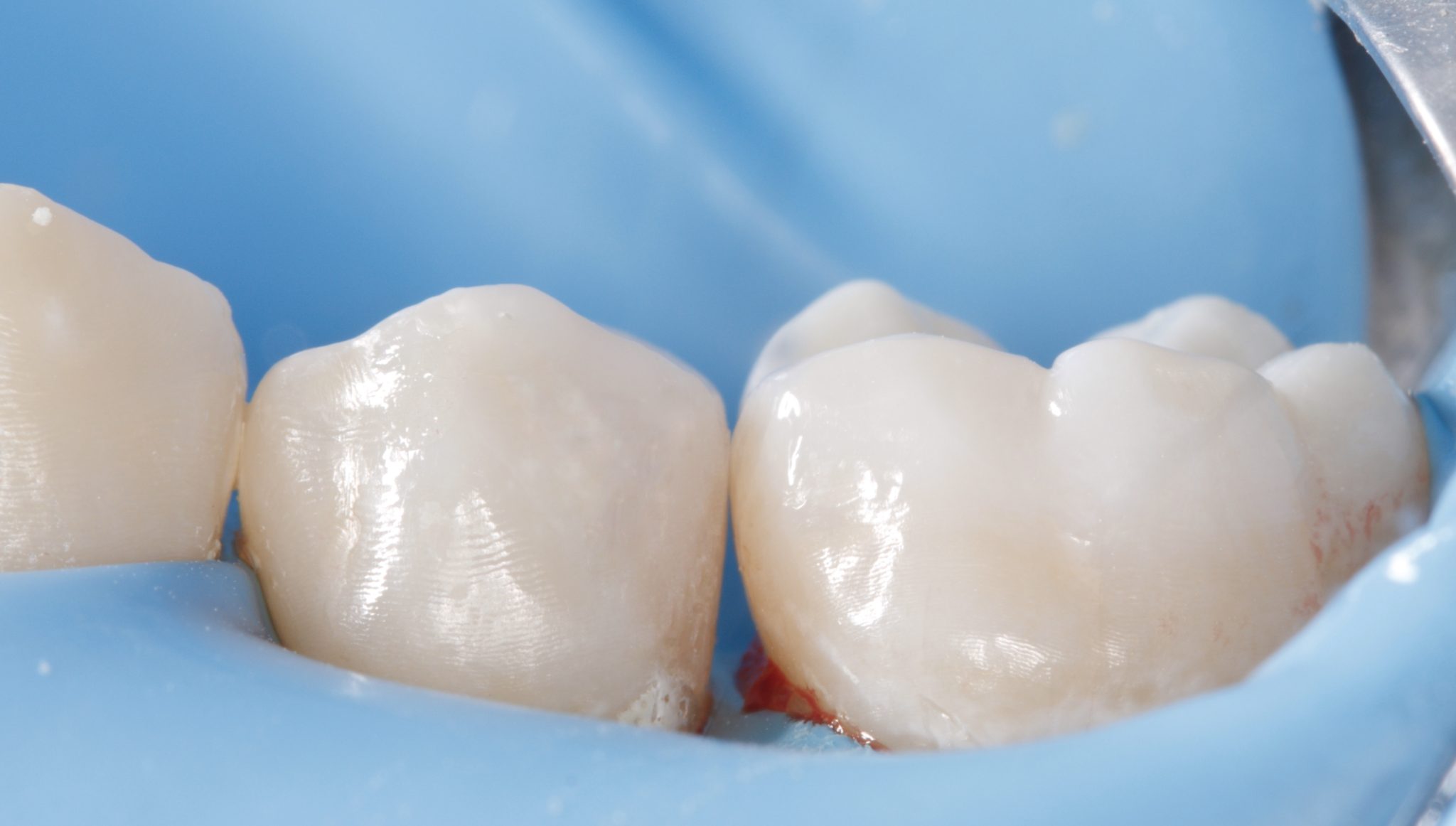 “Class II Direct Composite Restoration using Fiber-Reinforced Composite ...