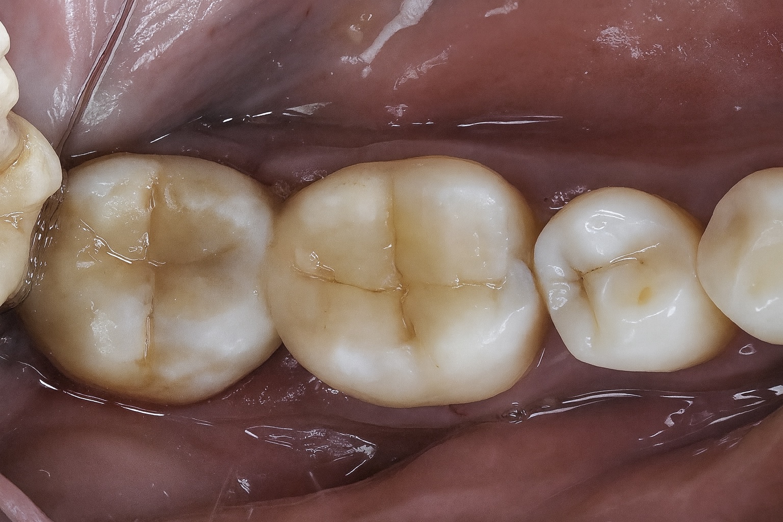 Class II Direct Composite Restorations with Sectional Matrix System – A ...