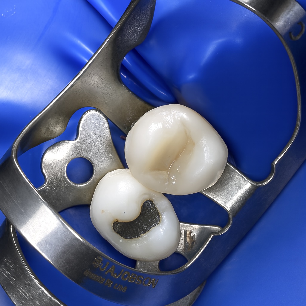 Endodontic Management and Adhesive Restoration of maxillary Premolar ...