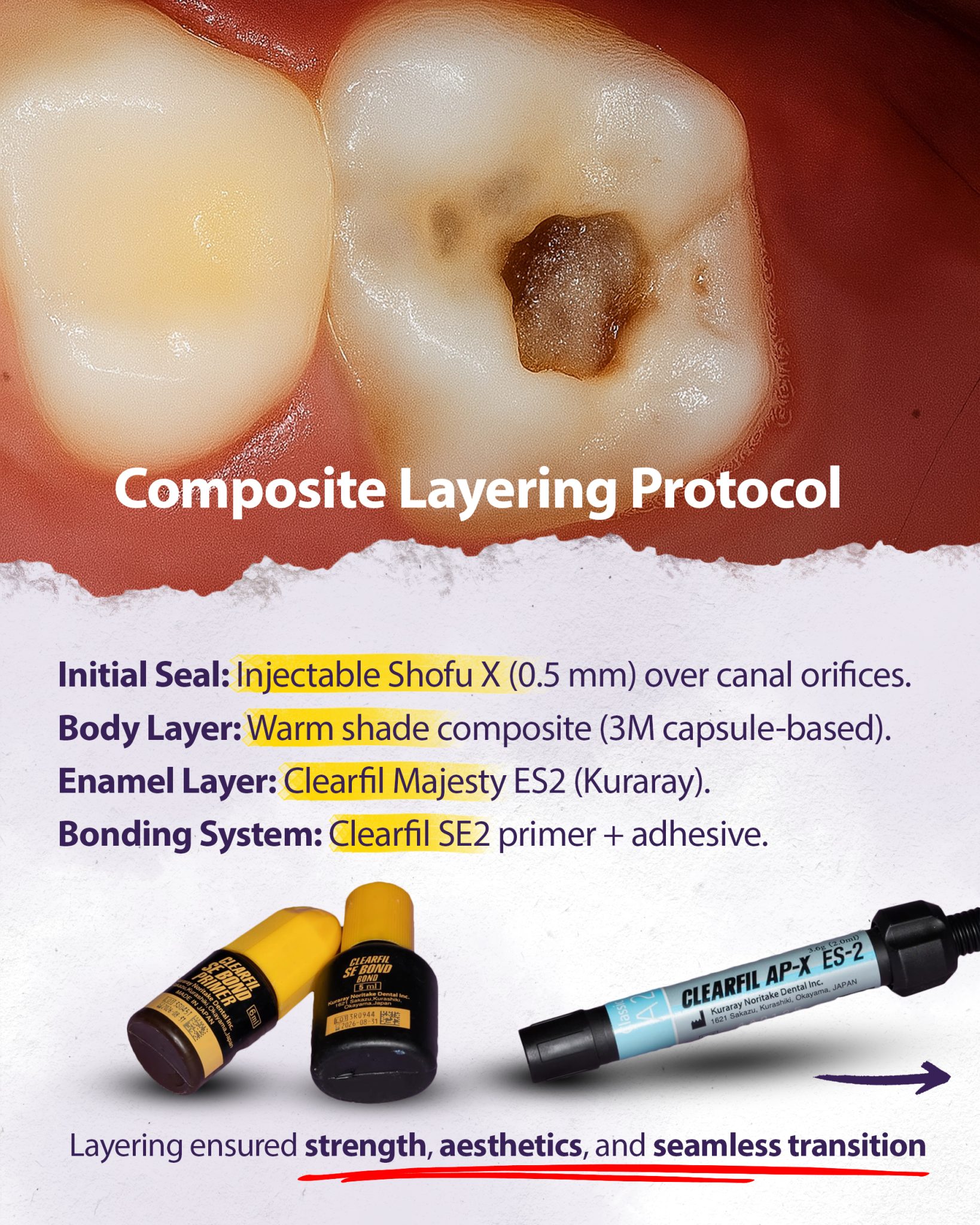 Bioceramic-Based Endodontic Management and Cuspal Coverage Restoration ...