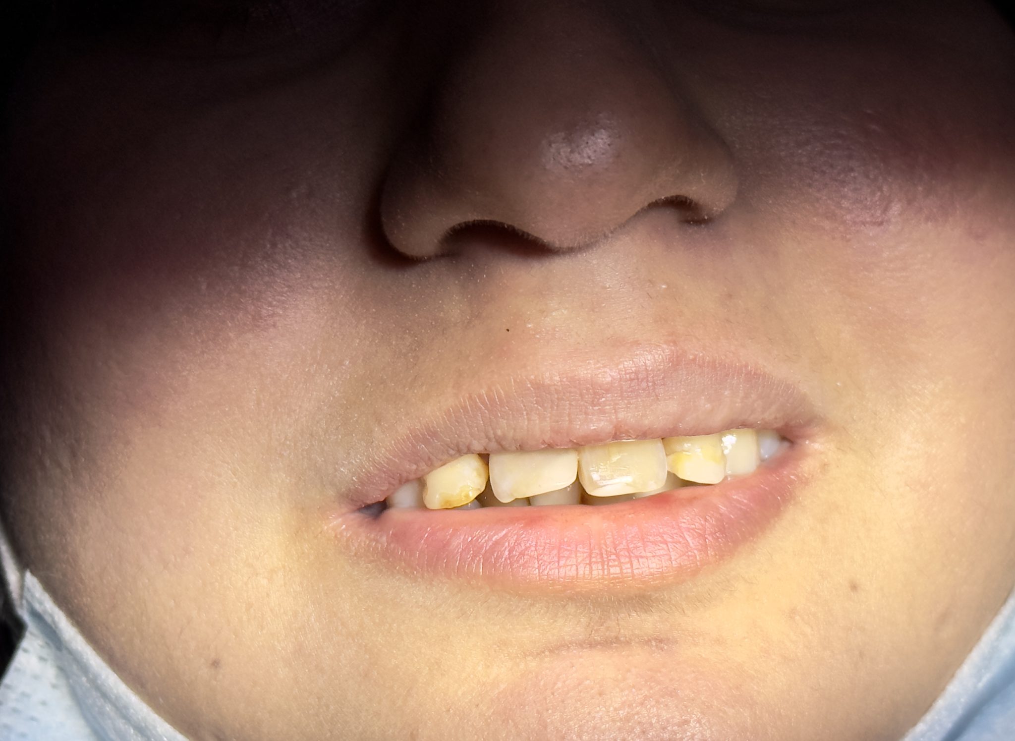 Comprehensive Smile Rehabilitation Using E.max Crowns in a Patient with ...