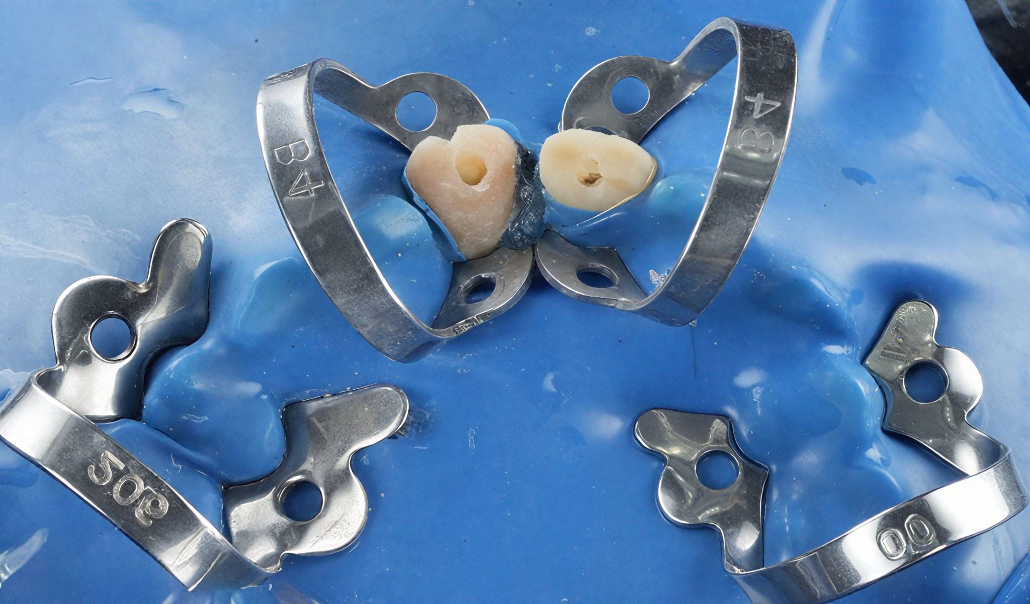 Microscope-Guided Endodontic Management of Mature Traumatized Maxillary ...