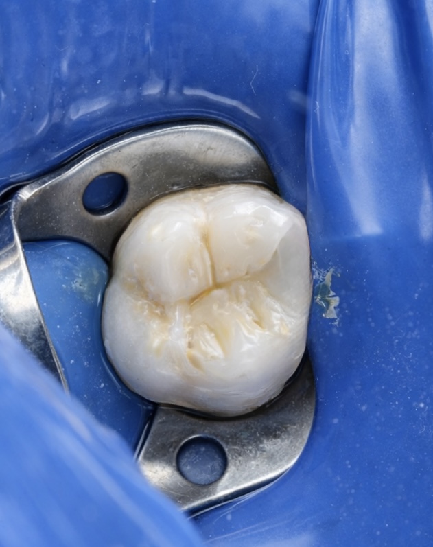 Endo-Restorative Management of a Maxillary Molar with MB2 - MyZerodonto