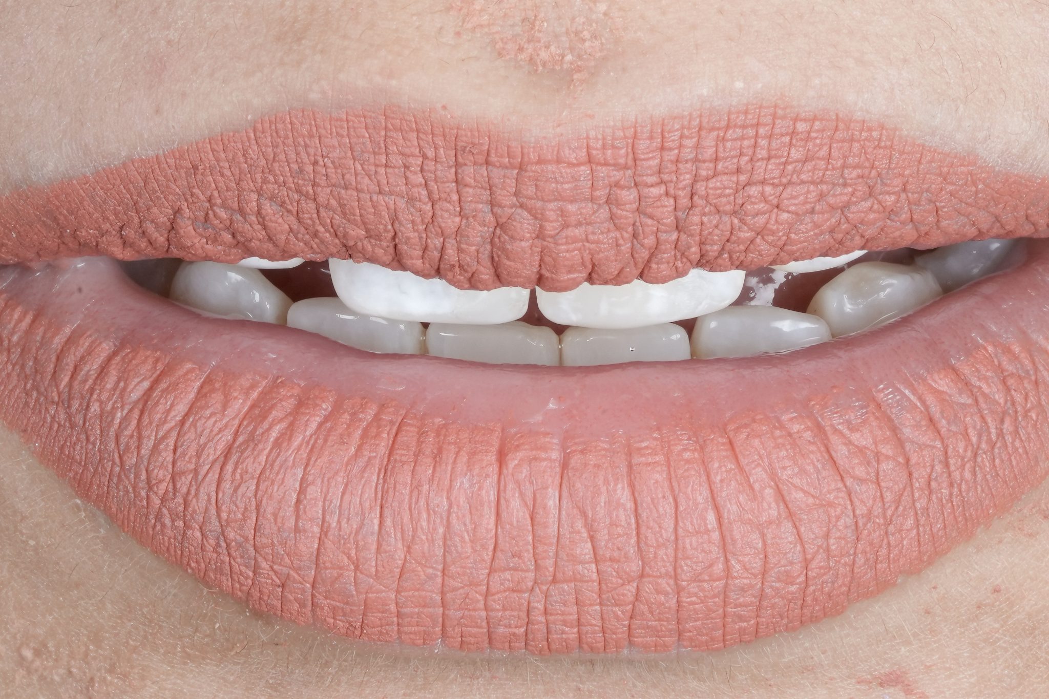 No-Preparation Composite Veneers for Diastema Closure: - MyZerodonto