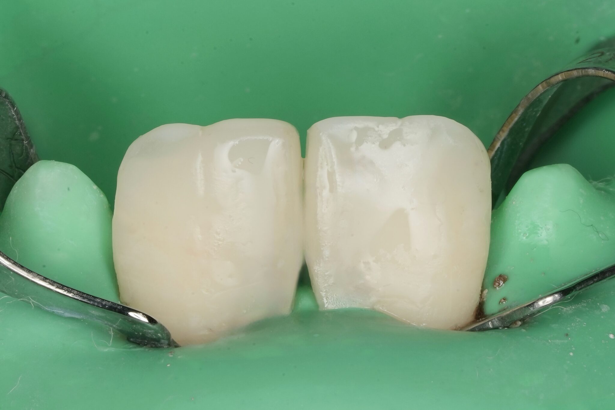Large Diastema Closure with Direct Composite Veneers A Digital ...